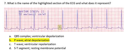 Hyperkalemia Ecg Cat Hyperkalemia Ecg Cat