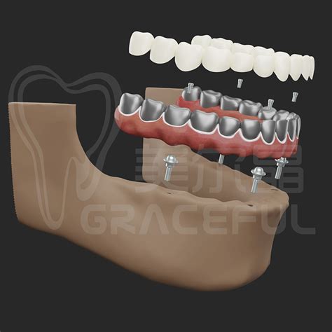 high quality titanium framework zirconia crowns factory and