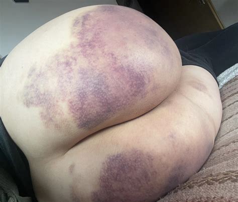 Two Days After Spanking 3 Pics Xhamster