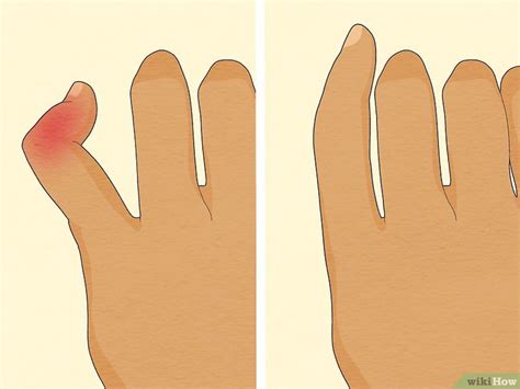 How To Determine If A Finger Is Broken Symptoms More