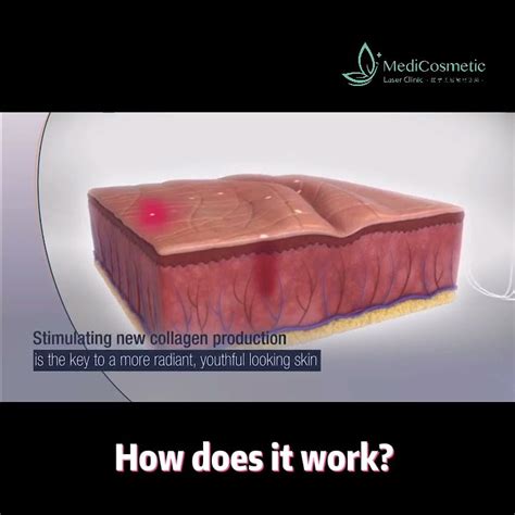 Check Out The Introduction For Lumenis M22 Treatment Book An