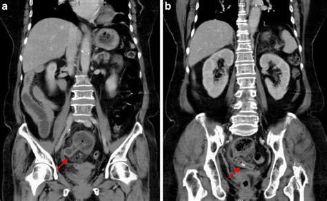 The Reconstructed Computed Tomography Revealed A Swollen Appendix With Download Scientific