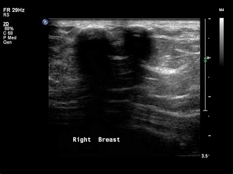 Atlas Of Breast Cancer Early Detection