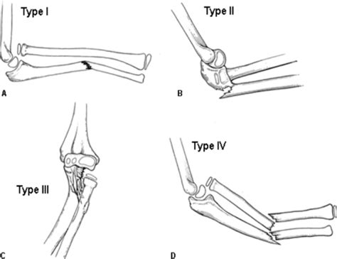 Elbow Injuries Flashcards Quizlet