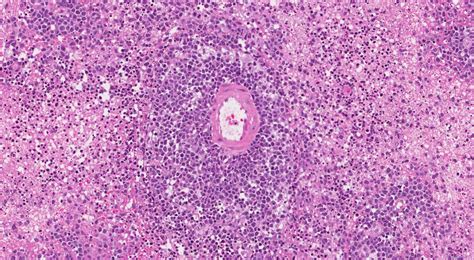 Primary Cns Diffuse Large B Cell Lymphoma Ottawa Atlas Of Pathology