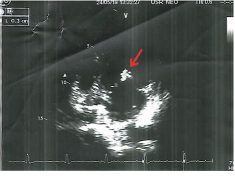 Table 1 From Human Disease Caused By Streptococcus Alactolyticus A Case Report Of Native Valve