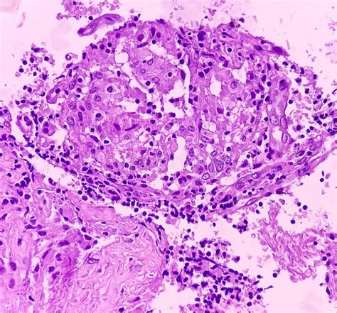 Thyroid Cancer Microscopic Image Of Follicular Neoplasm Malignant Neoplasm Of Atypical Thyroid