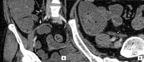 Computed Tomography Evaluation Of Variations In Positions And Measurements Of Appendix In