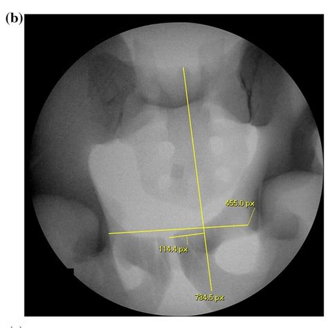 A Standard Anteroposterior Ap Pelvis Fluoroscopy Image Illustrating