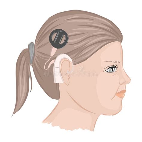 Profile Of A Girl With A Cochlear Device On Her Ear Stock Vector