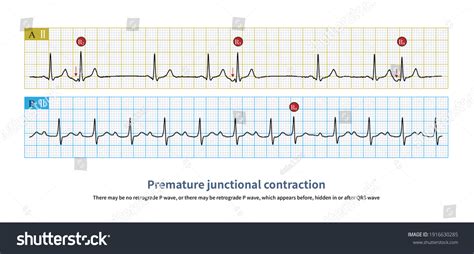 Premature Junctional Contraction P Wave