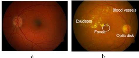 Figure 1 From Automated Retinal Hard Exudate Detection Using Novel