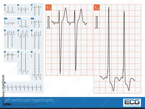In Left Ventricular Hypertrophy R Wave Amplitude In Lead V5 And S Wave Amplitude In Lead V1
