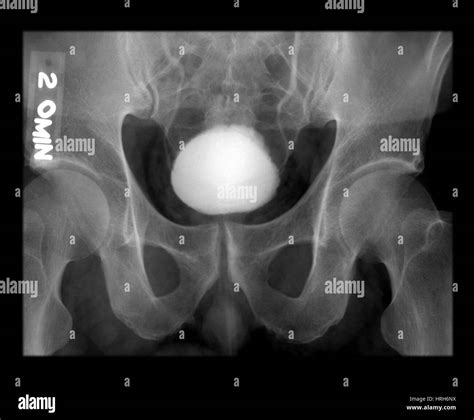 Normal Xray Of Urinary Bladder Stock Photo Alamy