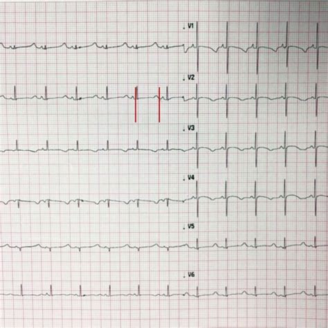 Flow Chart Of Fetal Bradycardia Diagnosis Courtesy Of The Book Yagel