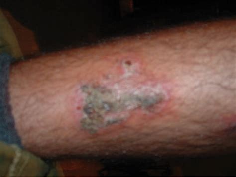 Figure 1 From A Cluster Of Ecthyma Outbreaks Caused By A Single Clone Of Invasive And Highly