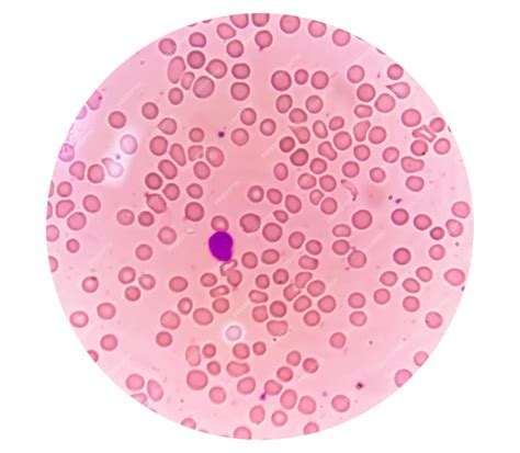 Premium Photo Acute Lymphoblastic Leukemia Or Acute Leukemia Under
