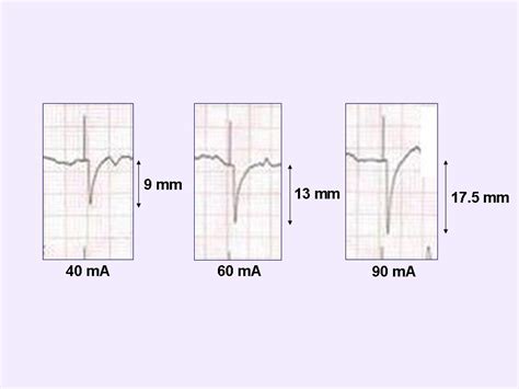 Transcutaneous Pacing Tcp The Problem Of False Capture