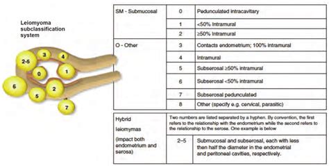 4 Figo Fibroid Subclassification System Reprinted Adapted By Download Scientific Diagram