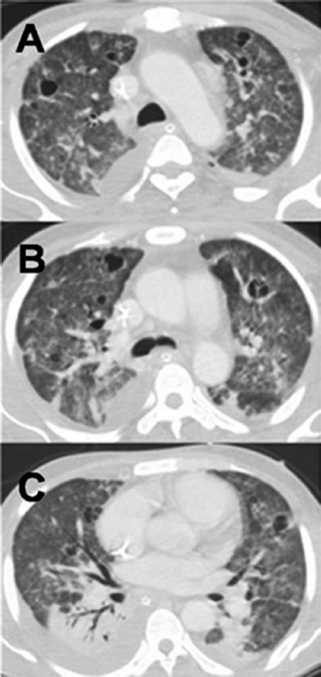 Axial Ct Scan With Contrast Lung Window At Diff Erent Levels