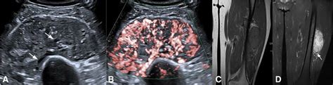 Sonography And Mri Of The Left Thigh A Gray Scale Ultrasound Reveals