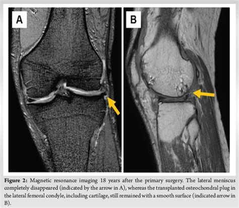 Re Arthroscopic Findings 18 Years After Osteochondral Autologous