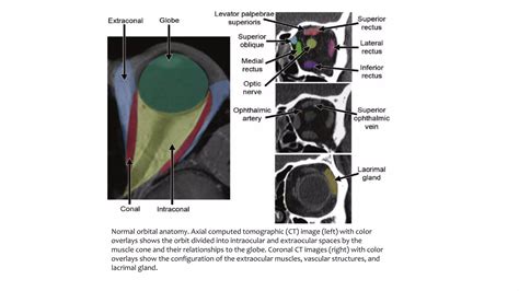 Orbital Fracture Management Pptx