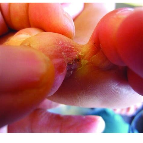 Pdf Tinea Pedis An Updated Review