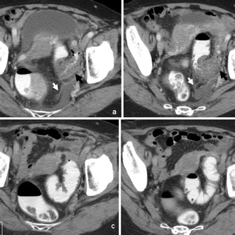 Pdf Ct Findings Of Misleading Features Of Colonic Diverticulitis