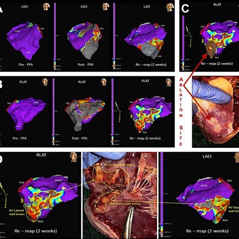 3d Mapping Assessment Of The Ablation Lesions Created Using The Linear