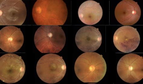 Ai Scholars Retinal Disease Classification