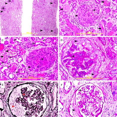 A Electron Micrograph Of A Glomerulus Showing Thickening Of Glomerular