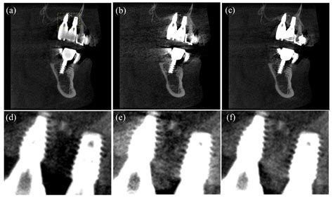Sensors Free Full Text Metal Artifact Reduction In Dental Cbct Images Using Direct Sinogram