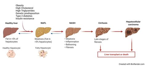 Fatty Liver Disease
