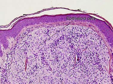 Neural Tumors Clinical Gateclinical Gate