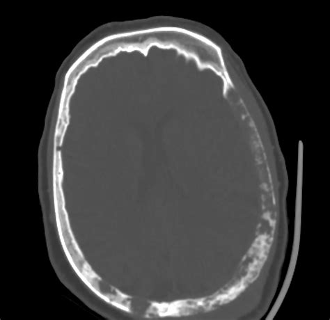 Breast Cancer Metastases Radiology Reference Article