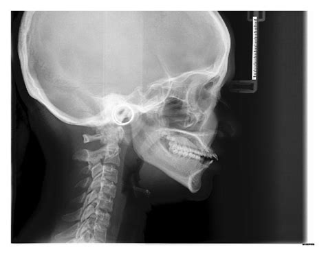 Lateral Cephalogram Of The Patient Download Scientific Diagram