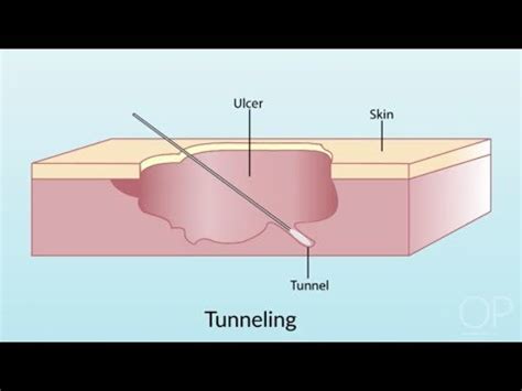 Tunneling Wound Vs Undermining Caption Simple