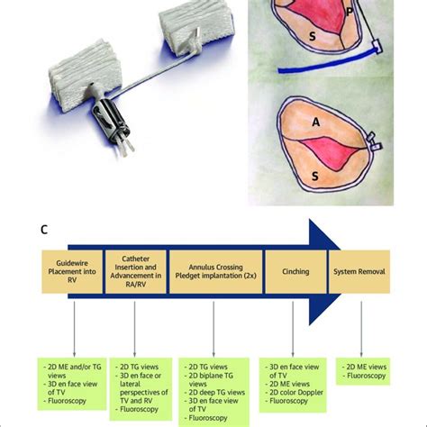 Download Pdf Imaging For Tricuspid Valve Repair And Replacement