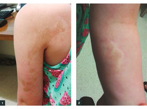 Linear Scleroderma