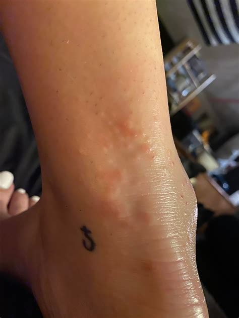 Ankle Rash Rmedicaladvice