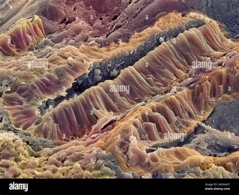 Ulcerative Colitis Coloured Scanning Electron Micrograph Sem Of Freeze Fractured Bowel Tissue