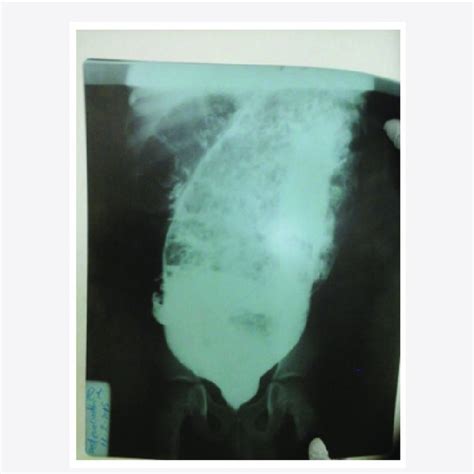 Loop Colostomy For Bowel Defunctioning Download Scientific Diagram