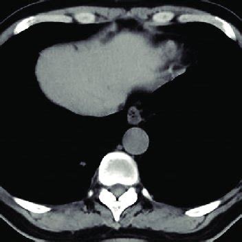A 51 Year Old Female Complained Of A Pulmonary Nodule Found By Physical Download Scientific