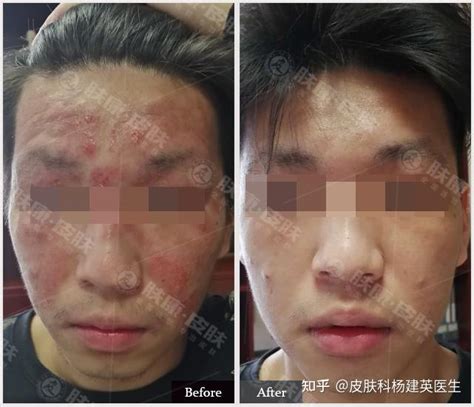 皮肤瘙痒起疙瘩越抓越多怎么办是好 知乎