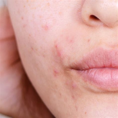 얼굴 화농성 모낭염 여드름 원인과 관리 안짜지는건 네이버 블로그