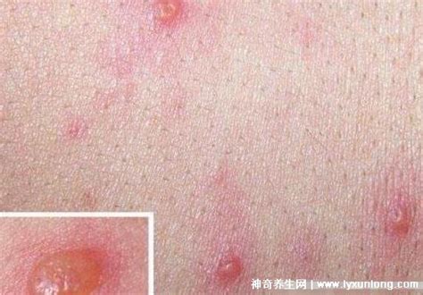 水痘的7天演变过程图片红色斑疹丘疹到疱疹结痂 15天痊愈 神奇养生网