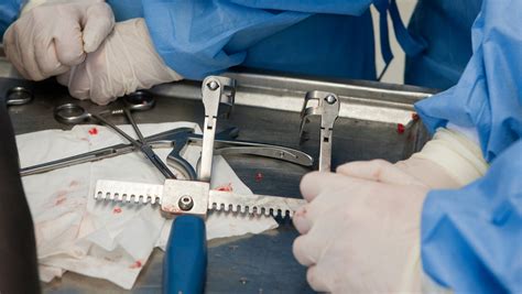 The Disturbing Case Of The Man Who Woke Up During His Autopsy