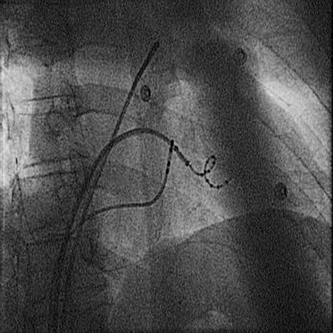 Entrapment Of Circular Mapping Catheter In The Mitral Subvalvular Apparatus During Segmental