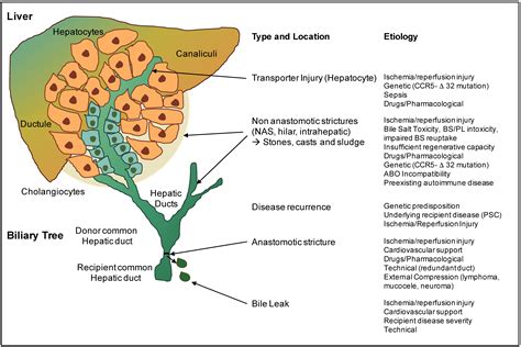 Impact Of Machine Perfusion On Biliary Complications After Liver